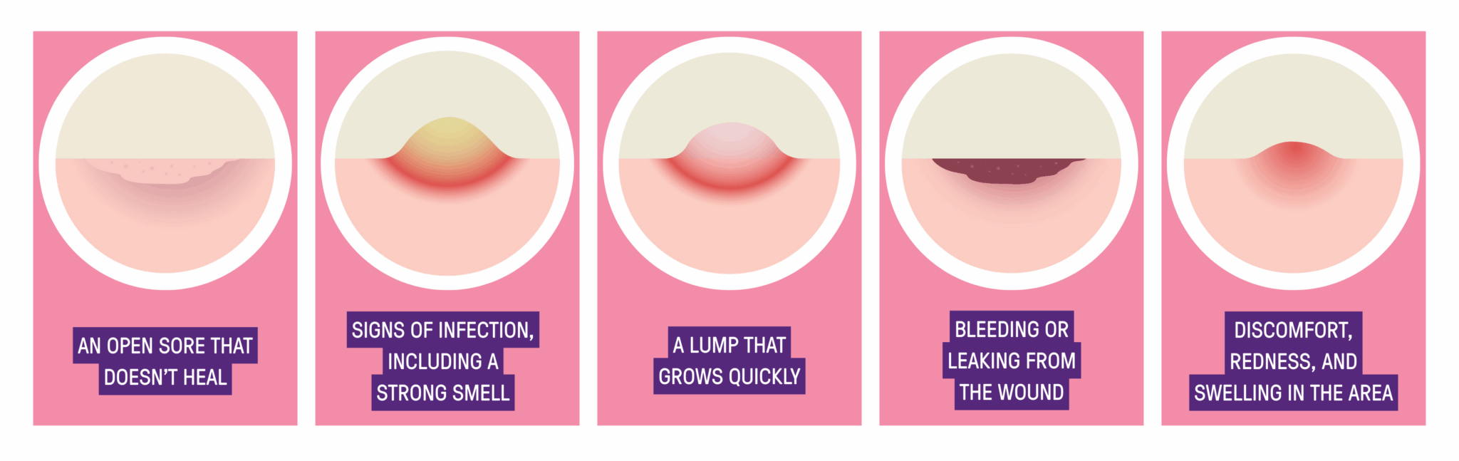 Fungating Breast Cancer | Breast Cancer Trials